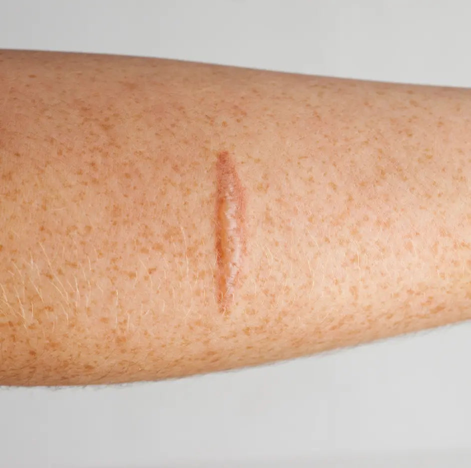 How Many Different Types of Scars Are There? A Complete Guide to Under ...