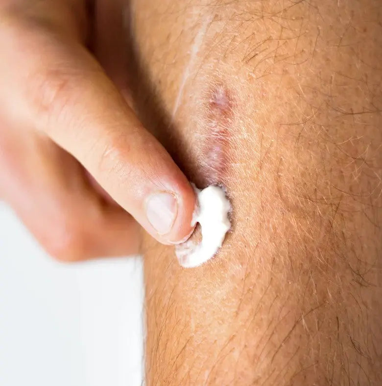 Understanding Different Types of Scars: A Comprehensive Treatment ...