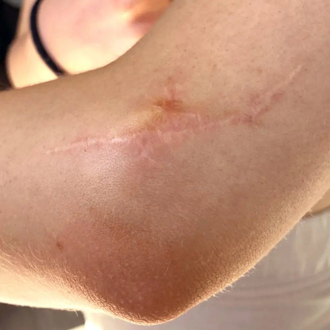 Types of scars on your skin – Genova Skincare